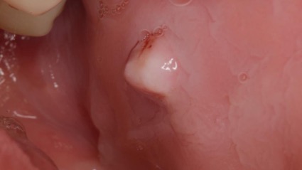 ¿Qué es un fibroma traumático? Causas y tratamiento